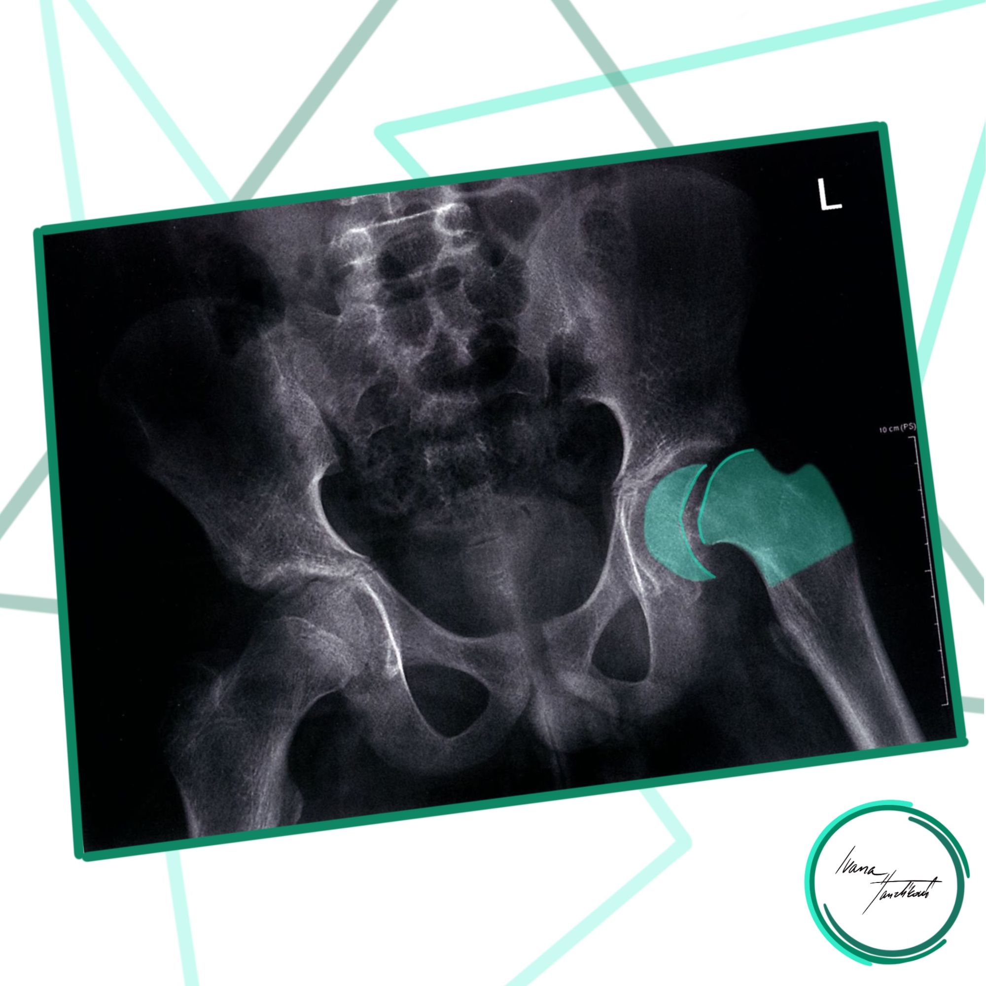 Slipped upper femoral epiphysis (SUFE)